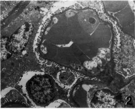 Electron Micrograph Of Early Diabetic Glomerulus 4 Months Of Age No Download Scientific
