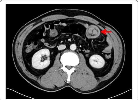Ct Scan Showing A Target Sign At The Jejunum Download Scientific Diagram