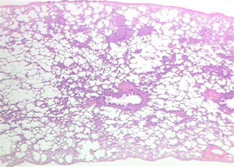 Study Provides Insights Into How Fibrosis Progresses In The Human Lung Family Medicine News