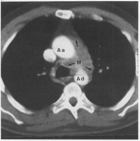Ct Of The Chest Showing Encasement Of The Aortic Arch By The Syphilitic