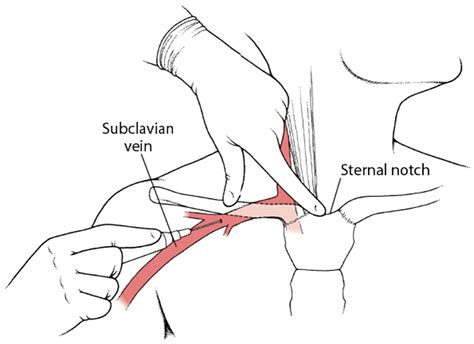 Image Subclavian Venipuncture Msd Manual Professional Edition