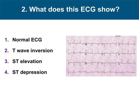 Ecg Interpretation Nstemi Pptx