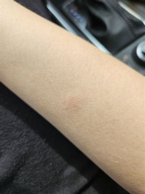 Raised Patch And Not Itchy More Than 2 Weeks Now Any Idea R