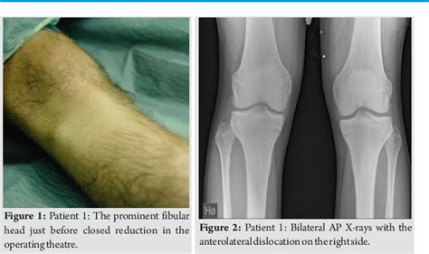 Proximal Tibiofibular Joint Injury