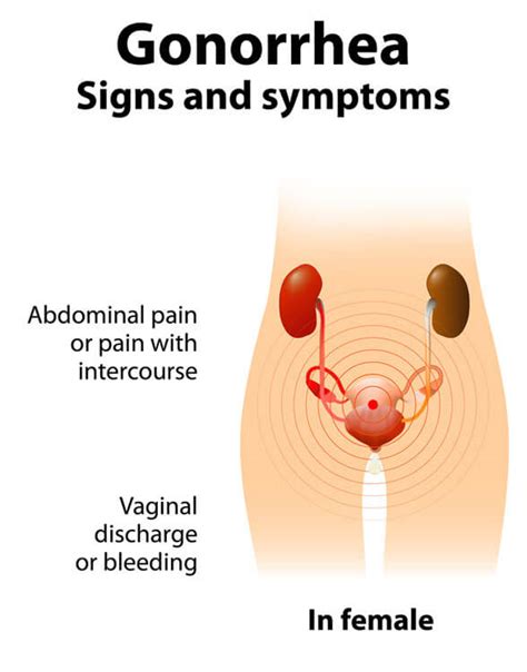 Gonorrhea Clap Symptoms Signs Causes Treatment