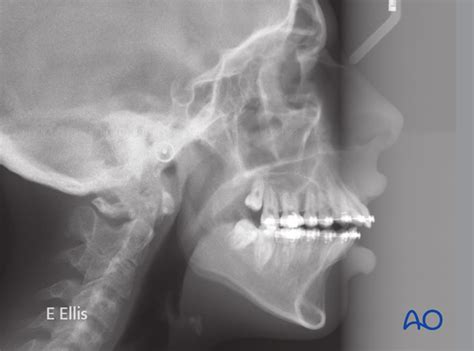 Vertical Maxillary Hyperplasia