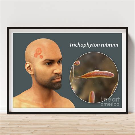 Ringworm 60 Poster By Science Photo Library Science Photo Gallery