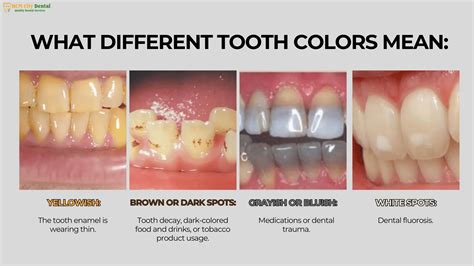 Brown Stains On Teeth Causes And Fixes Dental Secrets Dr Cuong Ho