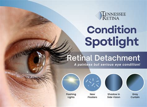 Retinal Detachment Know The Signs Act Quickly Tennessee Retina
