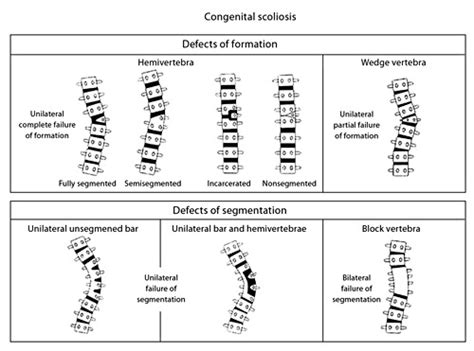 Schematic Diagram Of Spine Illustrating Defects Of Formation Wedge And Download Scientific