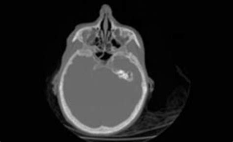 Edge Preserving Image Fusion Using Rms Contrast And Linear Prediction