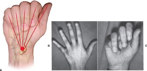 Injuries Of The Hand Musculoskeletal Key