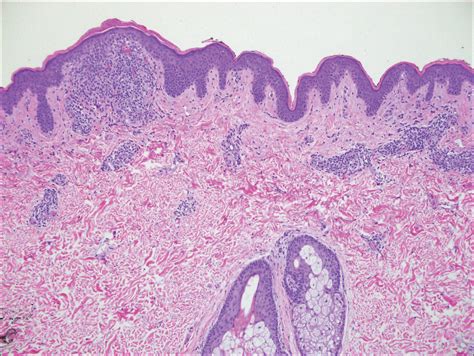 Blaschkoid Unilateral Patch On The Chest Mdedge