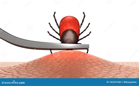 How To Remove A Tick The Correct Way Using Forceps 3d Rendering