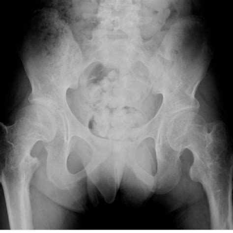 Radiographs And Diagrams Showing The Hip Classification System In