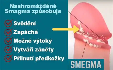Smegma A Zdraví Jaké Jsou Příčiny A Jaké Jsou Možnosti Léčby