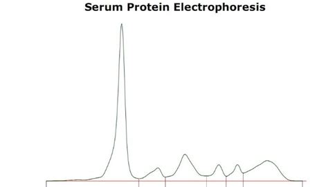 Demystifying Protein Electrophoresisfree Light Chains Immunotyping