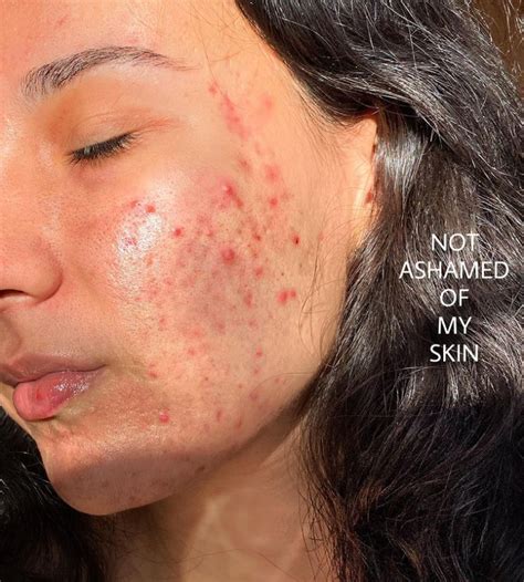 How Do I Look Sofia Grahn On Acne Artofit