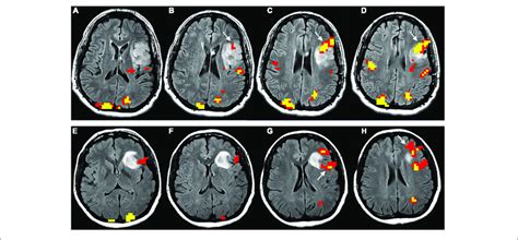 Functional Reorganization Of Language In Two Right Handed Patients Download Scientific