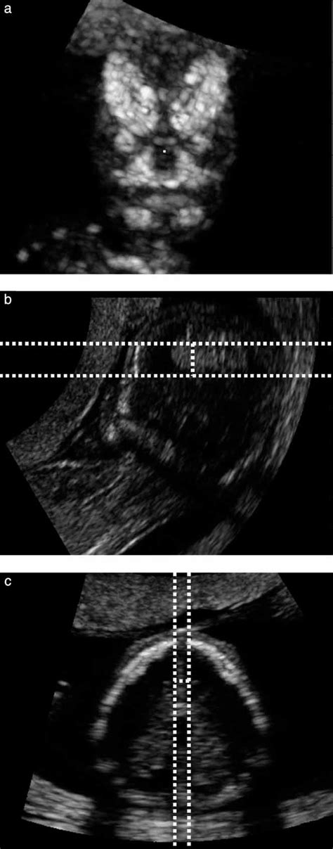 Metopic Suture In Fetuses With Trisomy 21 At 11 0 To 13 6 Weeks Of