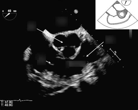 Midesophageal RV Inflow Outflow View Diagram Quizlet