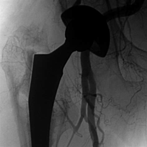 Unusual Embolization Of Hip Replacement Pseudotumor Direxion