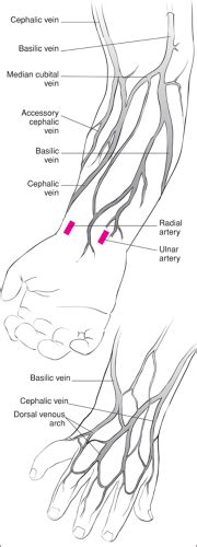 Arteriovenous Access Upper Hemodialysis Vascular Grafts Fistulas Bridge