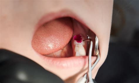 Understanding Reversible Pulpitis Symptoms A Complete Guide