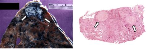 Chronic Inflammation Flashcards Quizlet Chronic Inflammation Flashcards Quizlet