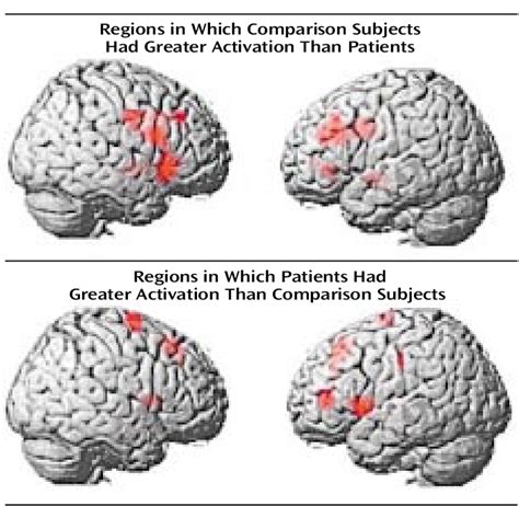 Hypofrontality And Hyperfrontality During Twoback Working Memory Task