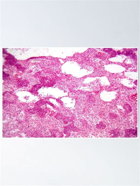 Lymph Node Cells Under The Microscope Poster For Sale By Zosimus