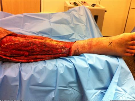 Pic Wtf Friend Fasciitis Necrotizing Had Stepdad 683812b [wtf] My Friends Stepdad Had