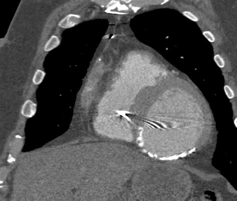109h Inferior Post Mi Vsd Repair Cad The Common Vein