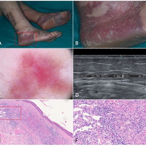 Patch Stage Kaposis Sarcoma Ab Active Patches On The Feet Of A