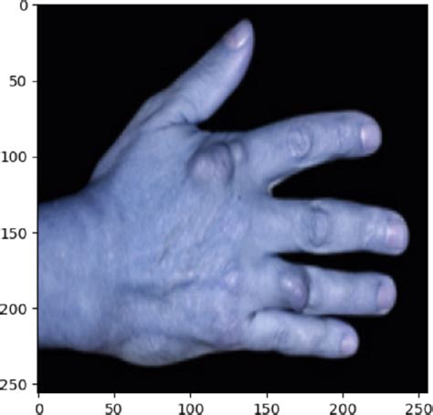 Figure 3 From Early Detection Of Rheumatoid Arthritis Using Image Classification Semantic Scholar