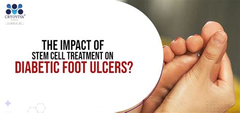 The Impact Of Stem Cell Treatment On Diabetic Foot Ulcers Cryoviva Blog