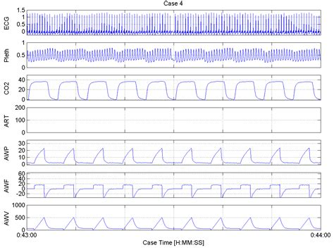 Case 4 Waveform Plots 60 Second Plots