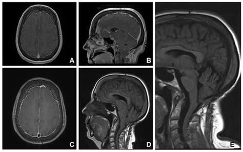 Cerebellar Tonsillar Descent Mimicking Chiari Malformation