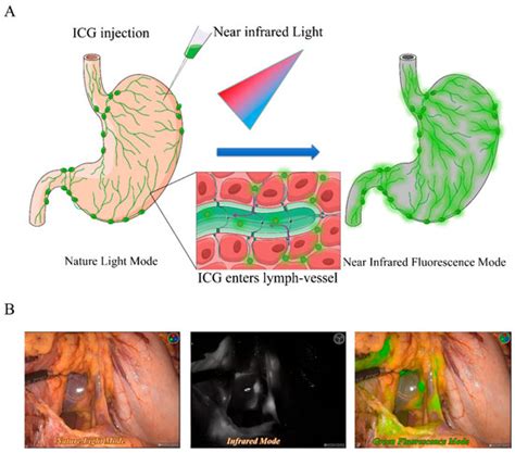 Mapping Lymph Node During Indocyanine Green Fluorescence Imaging Guided