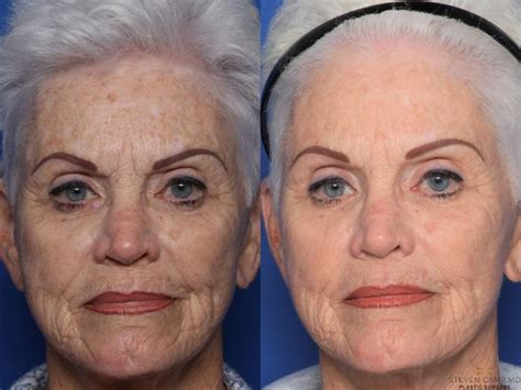 Sciton Laser Before And After Photo Gallery Fort Worth And Arlington