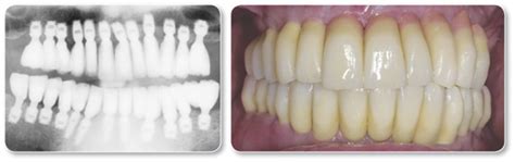 Bicon Dental Implants Introduction To The Bicon System Restorative