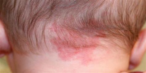 Salmon Patch Stamford Skin Centre