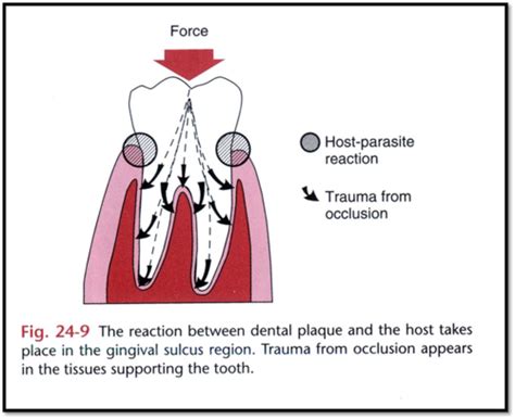 Occlusion And Tmj Disorders Flashcards Quizlet