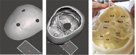 A B Stl Files For The 3 D Printed Phantom Brain Model C The Download Scientific Diagram