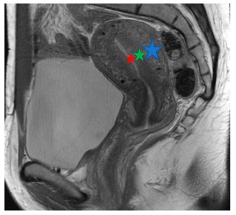 Mri Based Radiomics As A Promising Noninvasive Diagnostic Technique For