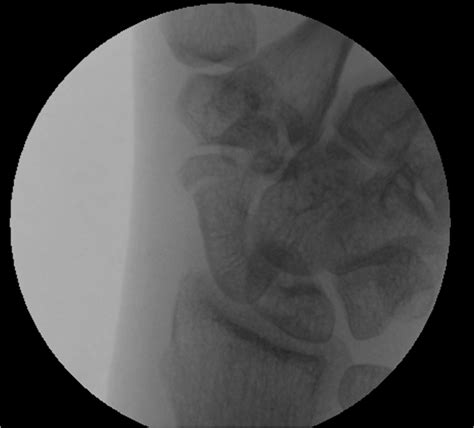 Joint Preservation And Replacement Distal Pole Scaphoid Fracture With Greisslers Grade III SL
