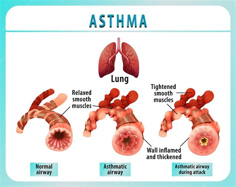 Asthma Pictures