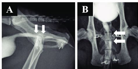 Retrograde Urethrography Showed A Stricture Of The Pelvic Urethra
