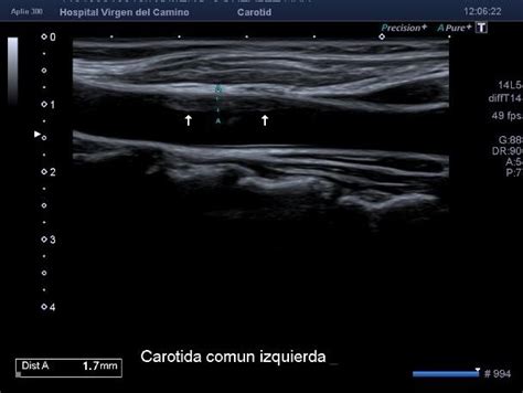 Subclavian Steal Syndrome Ultrasound