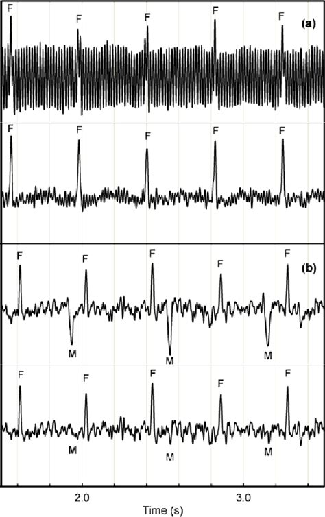 Figure 1 From Evaluation Of The Performance Of A Qrs Detector For